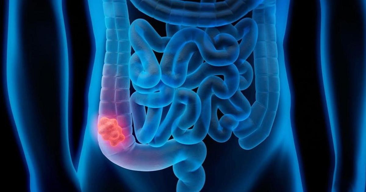 Καρκίνος παχέος εντέρου: Γιατί η πρόληψη πριν τα 45 είναι ζωτικής σημασίας | Alfavita